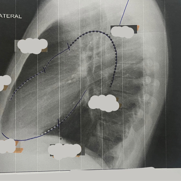 RX de Torax, proyección lateral, silueta cardiaca