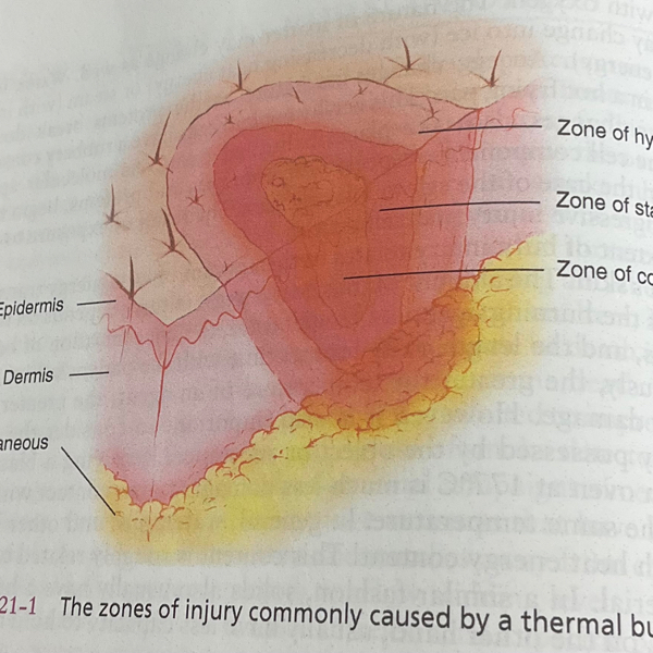 Zones of injury - thermal burn