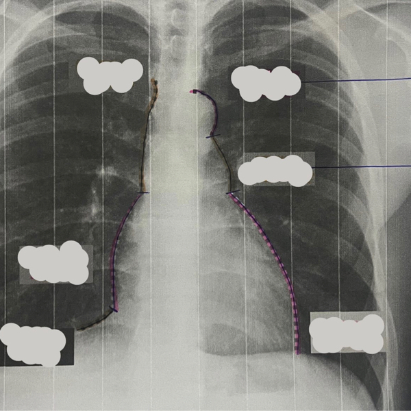 RX de Torax, proyección PA, silueta cardiaca