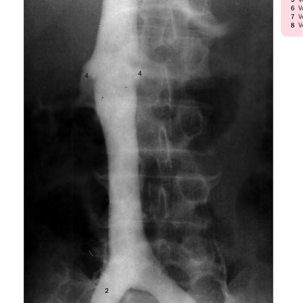Venografia vena cava inferior