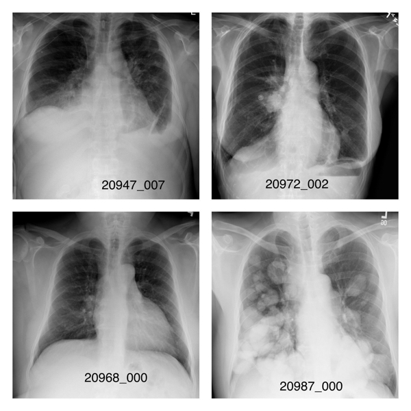 NIH chest- x Ray